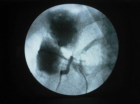 Chist Hidatic Hepatic Si Peritoneal