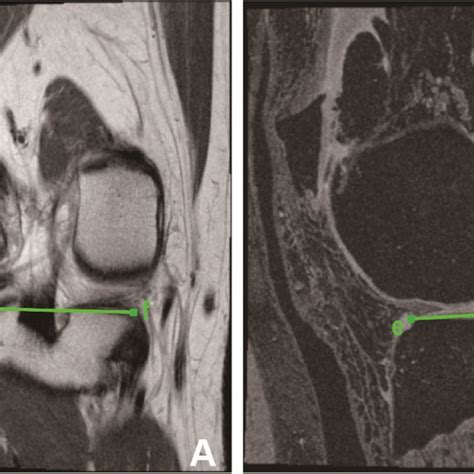 Measures Of Proximal Tibiofibular Joint Ptfj Morphological