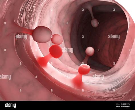 Polypen Des Dickdarms Fotos Und Bildmaterial In Hoher Auflösung Alamy