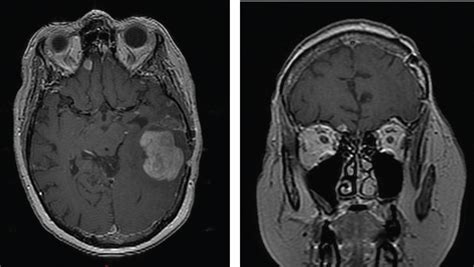 Frontal Lobe Brain Tumor Mri