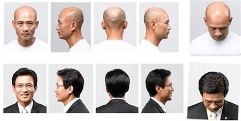 男士效果案例 织发补发植发假发织发补发多少钱与效果图 江苏南京aaa级诚信单位