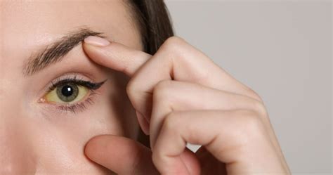 Signs Of Fatty Liver Disease That Show Up In Your Face The Hearty Soul
