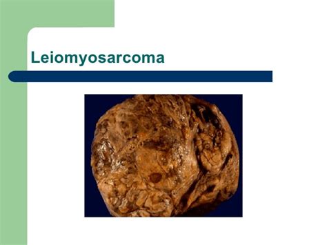 Uterine Sarcoma