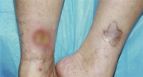 Mozzie Alert Horror As Flesh Eating Disease Spreads In Australia New