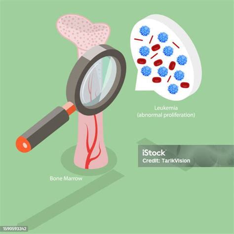 백혈병 질환의 3d 아이소메트릭 플랫 벡터 개념 그림 3차원 형태에 대한 스톡 벡터 아트 및 기타 이미지 3차원 형태 개념 건강 진단 Istock