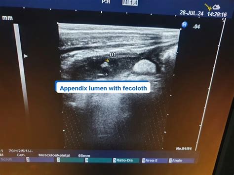 Haroon Khan On Linkedin Perforated Appendix With Mild Free Fluid