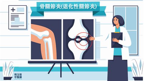 退化性關節炎骨關節炎是什麼 了解成因、檢查及治療方式 2025版 周文程中醫師
