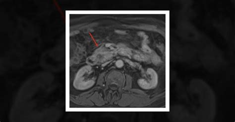 Myeloid Sarcoma Mimicking Pancreatic Mass Medsynapse