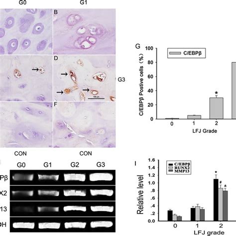 Expression levels of C EBPβ and RUNX2 were upregulated in human LFJ