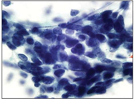 Liquid Based Cytology