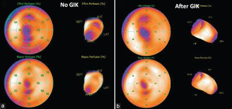 Cardioprotection With Glucose Insulin Potassium Gik During Non