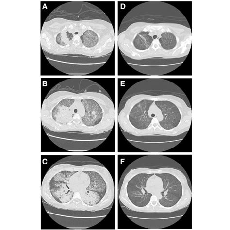 Noncontrast Ct Chest On Presentation And Following Treatment A C