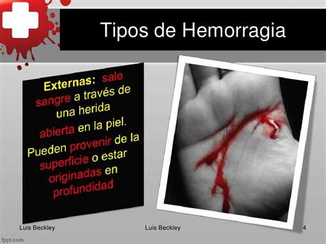 Quais São Os Tipos De Hemorragia Braincp