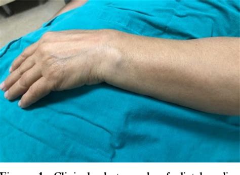 Figure 1 From Comparison Of Hematoma Block And Sedoanalgesia For