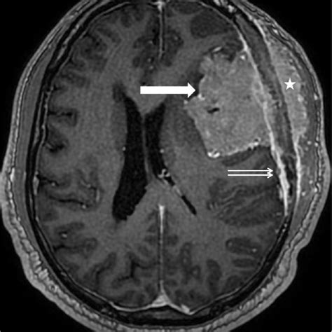 Axial T1 Sequence After Gadolinium Contrast Demonstrates The Large