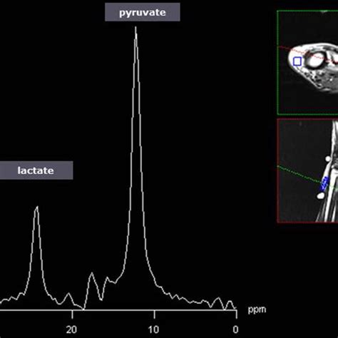 Single 13 C Csi Spectrum Visualizing The 13 C Lactate And 13 C Pyruvate Download Scientific