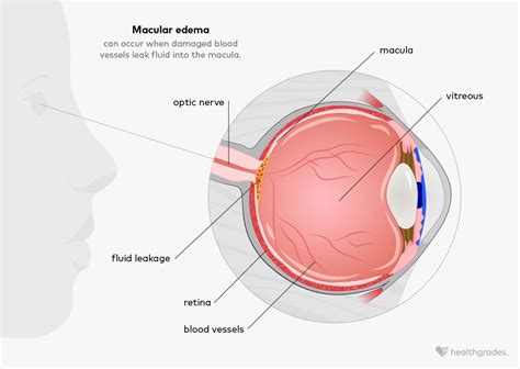 Macular Edema Causes Symptoms Diagnosis And Treatments
