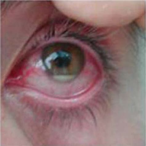 Uveitis With Hypopyon Download Scientific Diagram