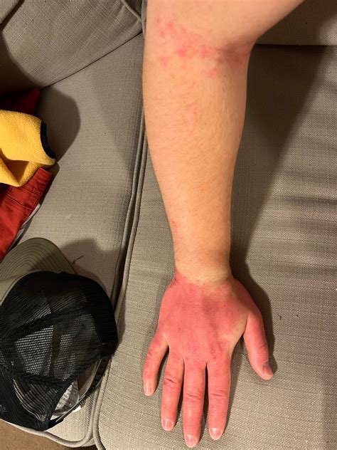 Is This Bad Enough To Consider Dupixent R Eczema