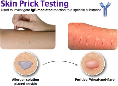 Dermatitis Flashcards Quizlet