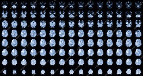 Premium Photo Mri Brain Axial Views To Evaluate Brain Tumor