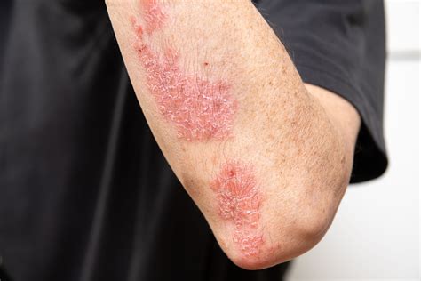 Jandj Submits Applications For Guselkumab To Treat Plaque Psoriasis Jpsa