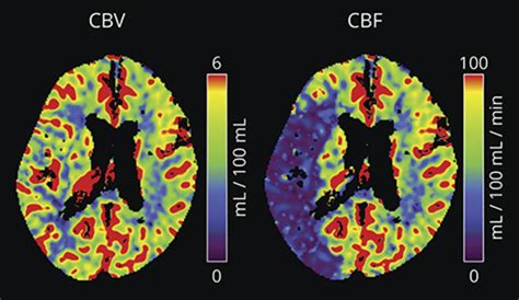 Spotlight On The November 23 Issue Neurology