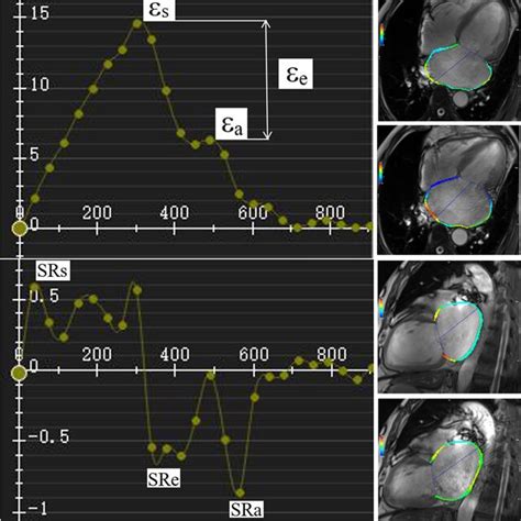 The Left Atrial La Strain And Strain Rate Curve Global Endocardial