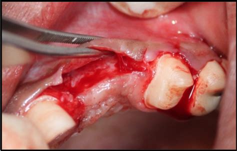 Soft Tissue Augmentation For Gingival Defect Using Connective Tissue Graft A Case Report