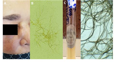 Figure 1 From A Case Of Cutaneous Phaeohyphomycosis Caused By