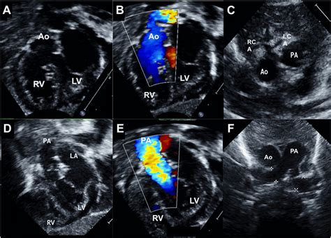 Echocardiogram Of First Patientcontinued Movie 2 Subxiphoid Shortaxis Download Scientific
