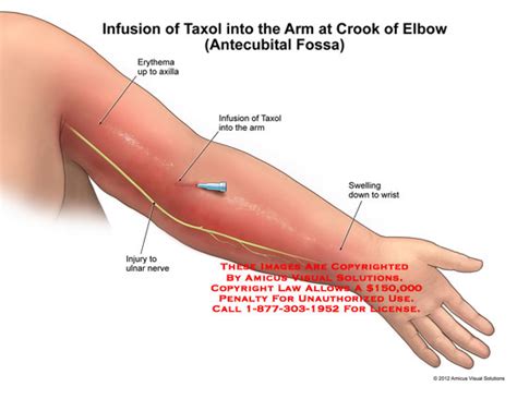 AMICUS Illustration Of Amicus Medical Arm Infusion Taxol Crook Elbow