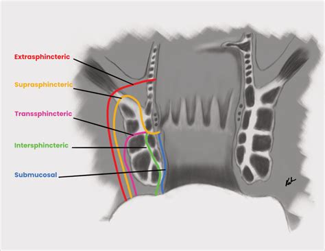 Anal Fistula Fistula In Ano Hyperexcision