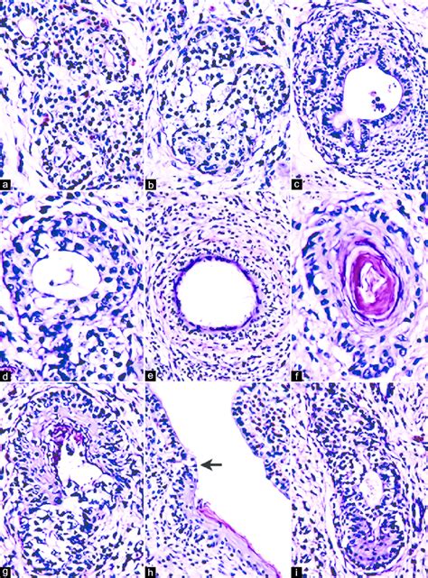 A Teratoma Represents Secretory Gland Composed Of Cuboidal Lined