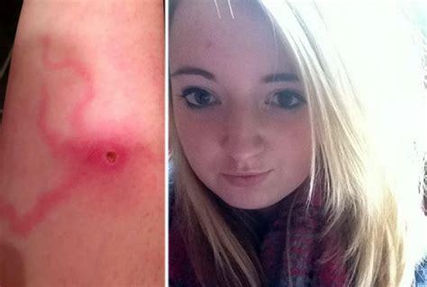 Spider Bite Fresher 18 Rushed To Hospital Mysterious Spider Bite
