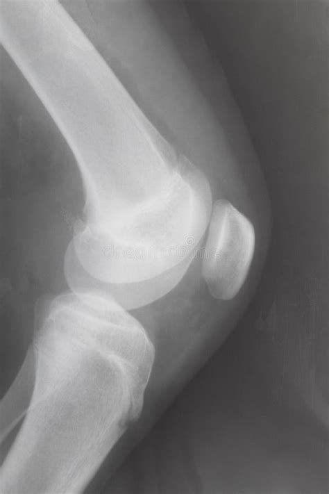 Human Knee Joint With Kneecap On X Ray Image Stock Image Image Of