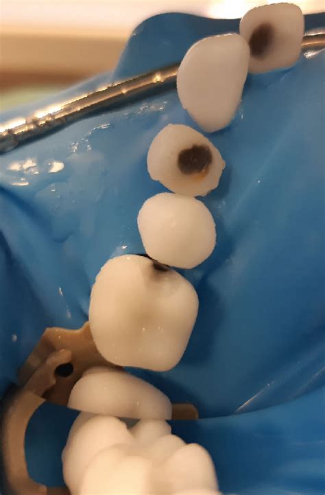 B Partially Prepared Cavity In The 3d Model Of The First Mandibular