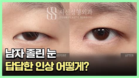 남자 졸린 눈 답답한 인상 어떻게 절개눈매교정 앞트임 Youtube