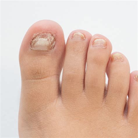 水虫（足白癬） 白根医院｜皮膚科：島根県安来市荒島町1817 1の一般・小児皮膚科・美容皮膚科｜松江からも好アクセス｜只今「帯状疱疹：定期