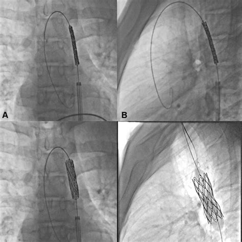 Steps Of Endovascular Stent Implantation For Aortic Coarctation