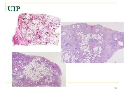 Ppt Approach To The Open Lung Biopsy Pattern Analysis Powerpoint