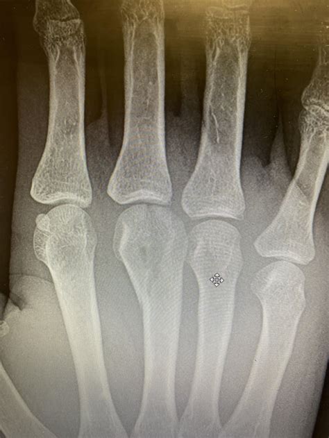 Boxers Fracture Of The 3rd Metacarpal Rradiology