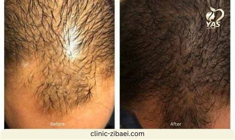 عکس قبل و بعد کاشت مو کلینیک زیبایی یسنا