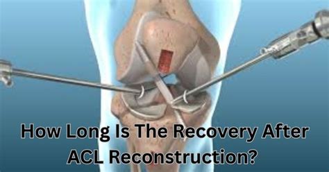 How Long Is The Recovery After Acl Reconstruction Bouncer News — Your Hub For News Guest
