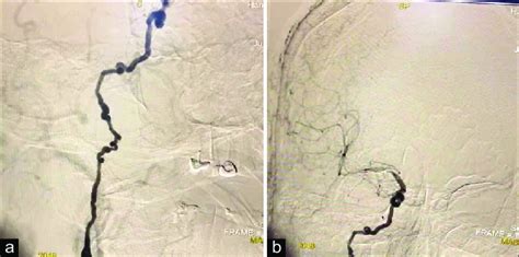 A Preoperative Digital Subtraction Angiography Demonstrating