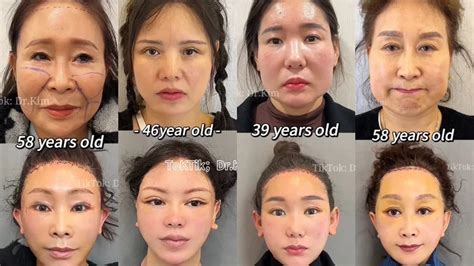 ¿quién Es Dr Kim El Cirujano Cuyo Rejuvenecimiento Extremo Horroriza Y Cautiva A Usuarios De