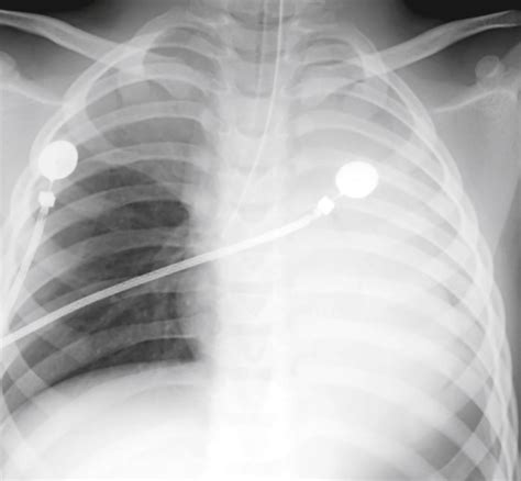 Recognizing Atelectasis Clinical Tree
