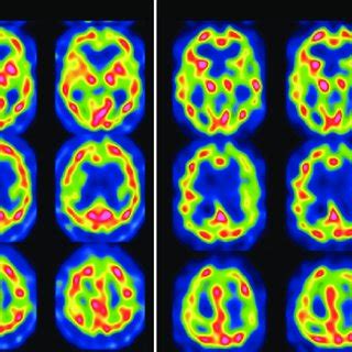 Preoperative Single Photon Emission Computed Tomography Findings Of