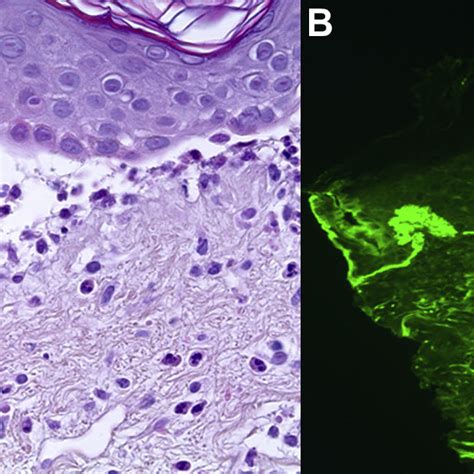 Indirect Immunofluorescence Using Salted Split Skin Shows The Presence