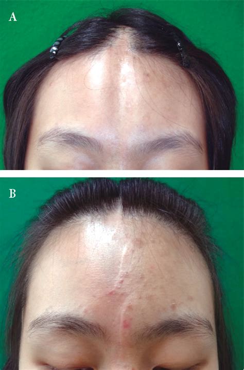 Figure 1 From Surgical Management Of Localized Scleroderma Semantic Scholar